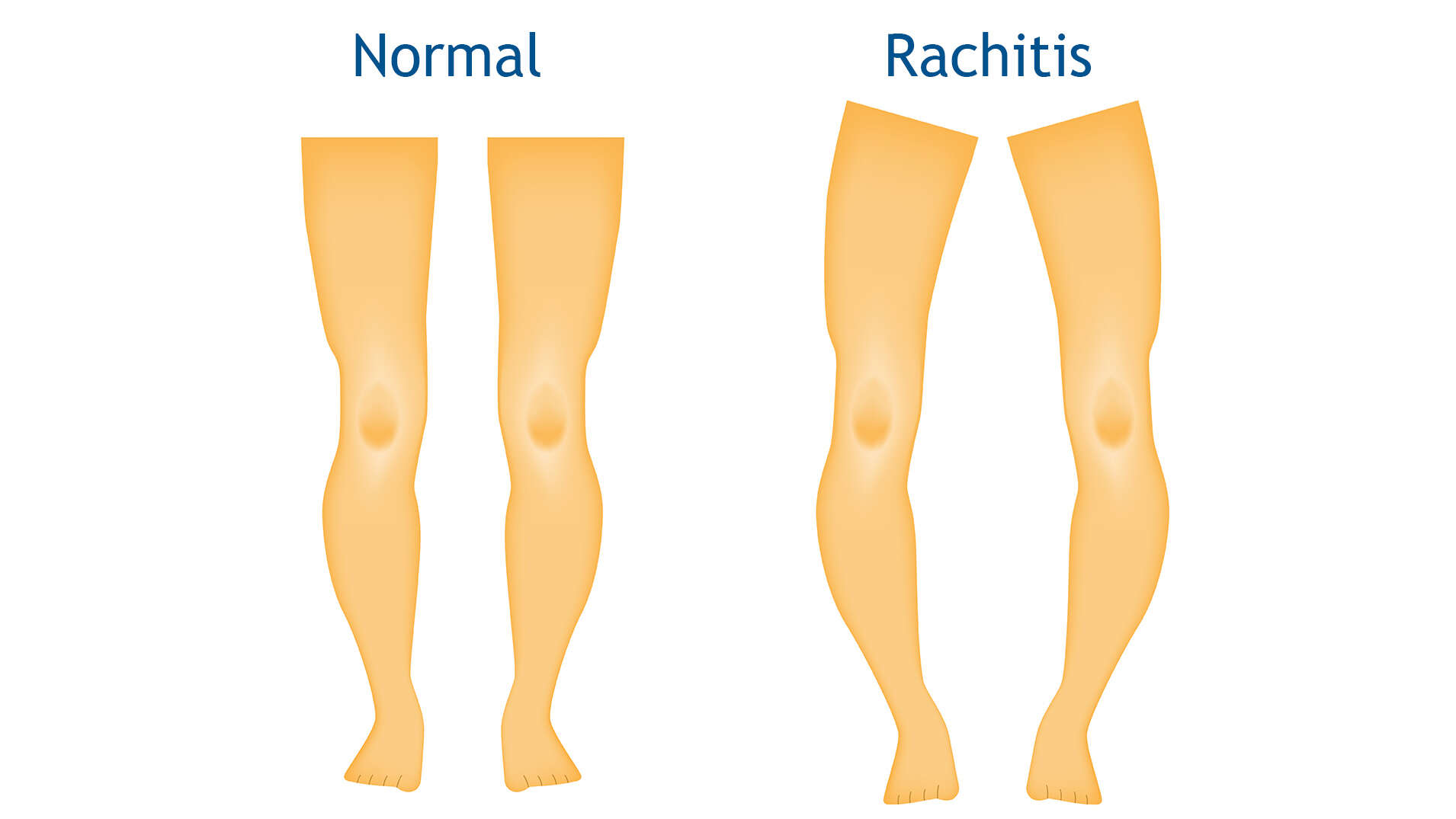 Vitamin-D-Mangel-Rachitis | Vitamin-D-Ratgeber.de